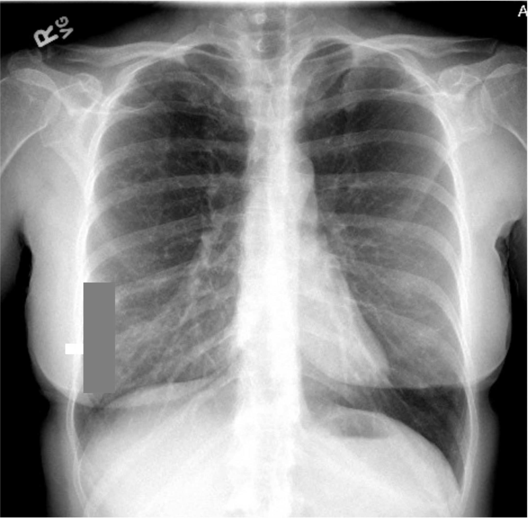 5. A Case of Chronic, Productive Cough | PulmPEEPs