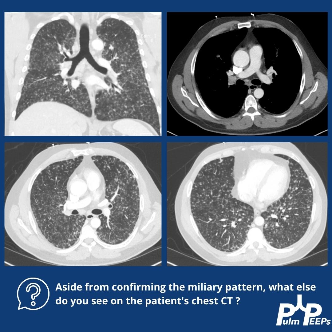 Radiology Rounds – 2/22/22 | PulmPEEPs