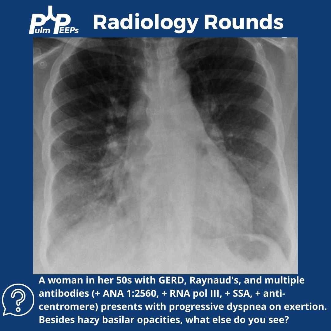 Radiology Rounds – 3/22/22 | PulmPEEPs