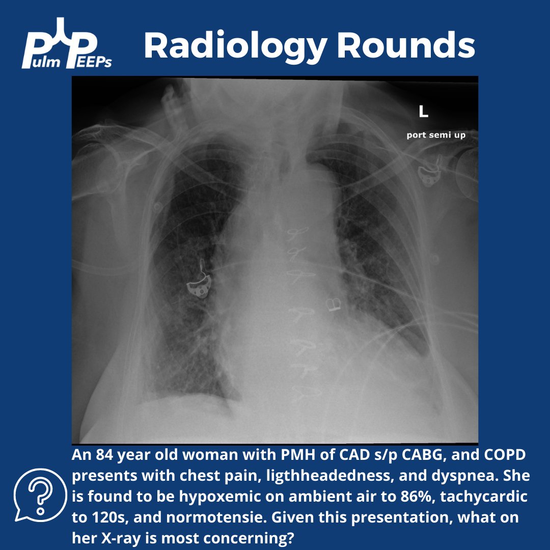 Aortic dissection | PulmPEEPs