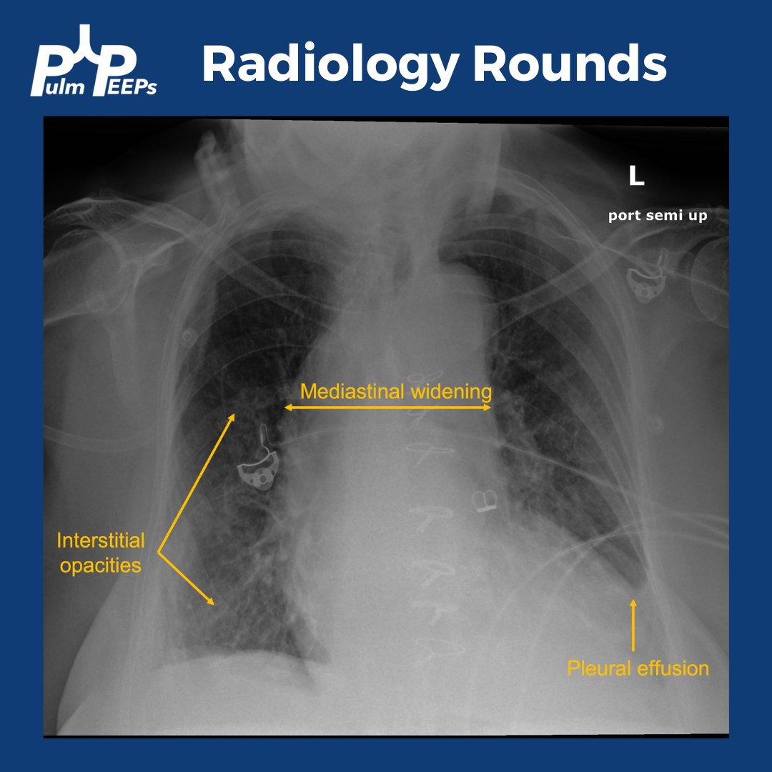 Aortic dissection | PulmPEEPs