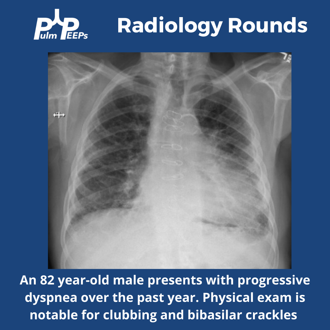 Radiology Rounds – 6/14/22 | PulmPEEPs