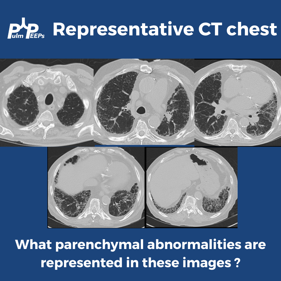 Radiology Rounds – 6/14/22 | PulmPEEPs