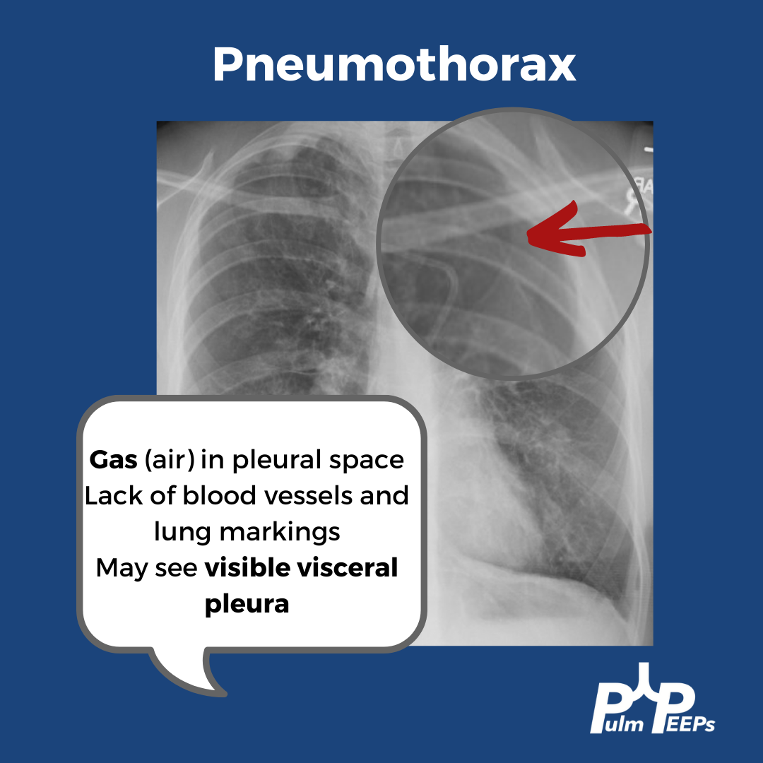 Pneumothorax | PulmPEEPs