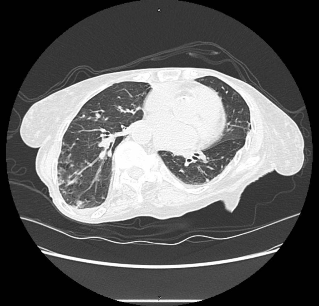 Radiology Rounds – 10/25/22 | PulmPEEPs