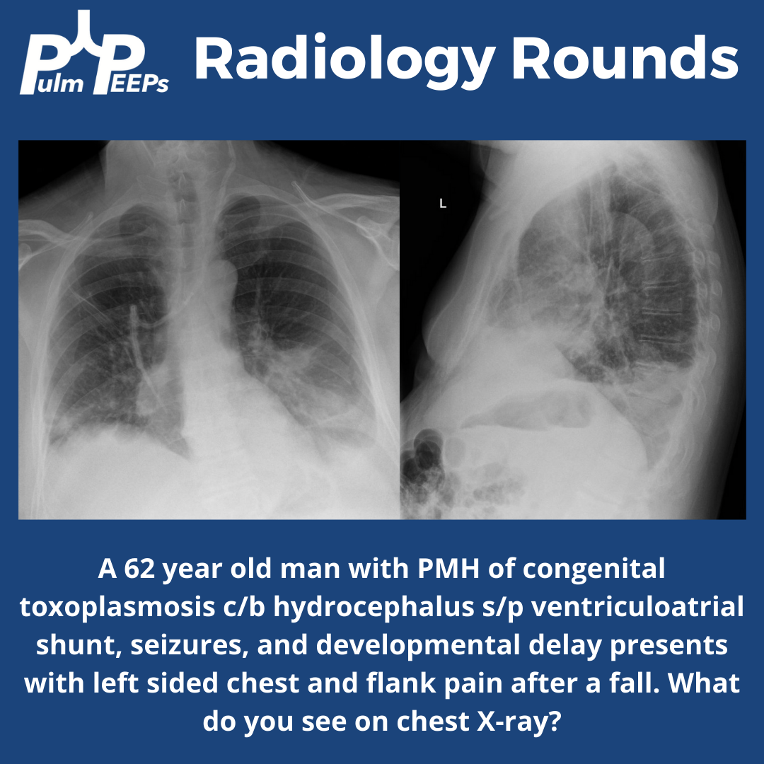 Pleural effusion | PulmPEEPs