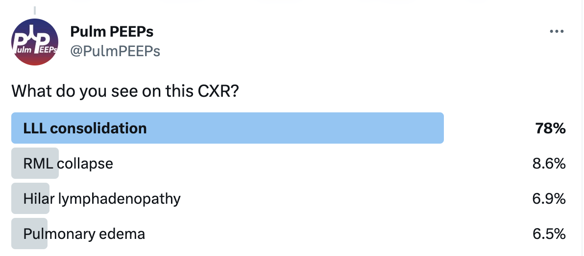 Pleural effusion | PulmPEEPs