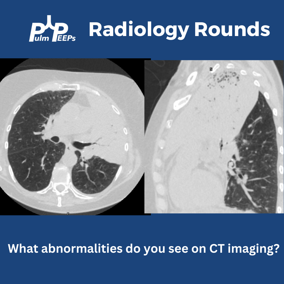 Radiology Rounds – 3/14/2023 | PulmPEEPs