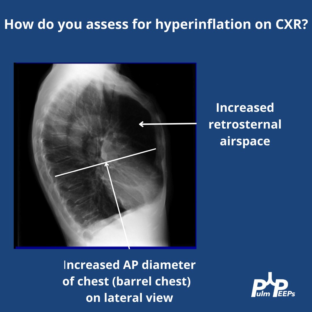 Radiology Rounds – 2/28/2023 | PulmPEEPs
