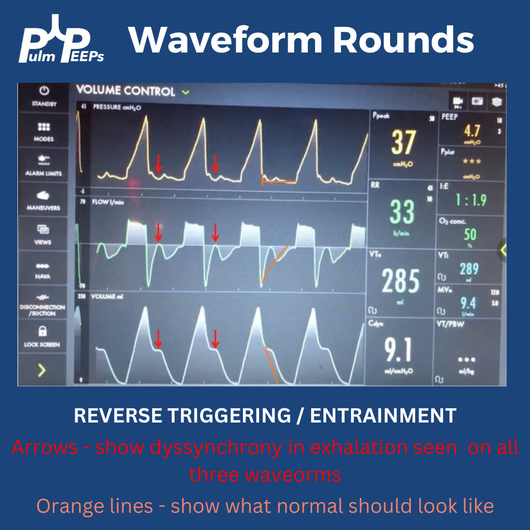 Mechanical ventilation | PulmPEEPs