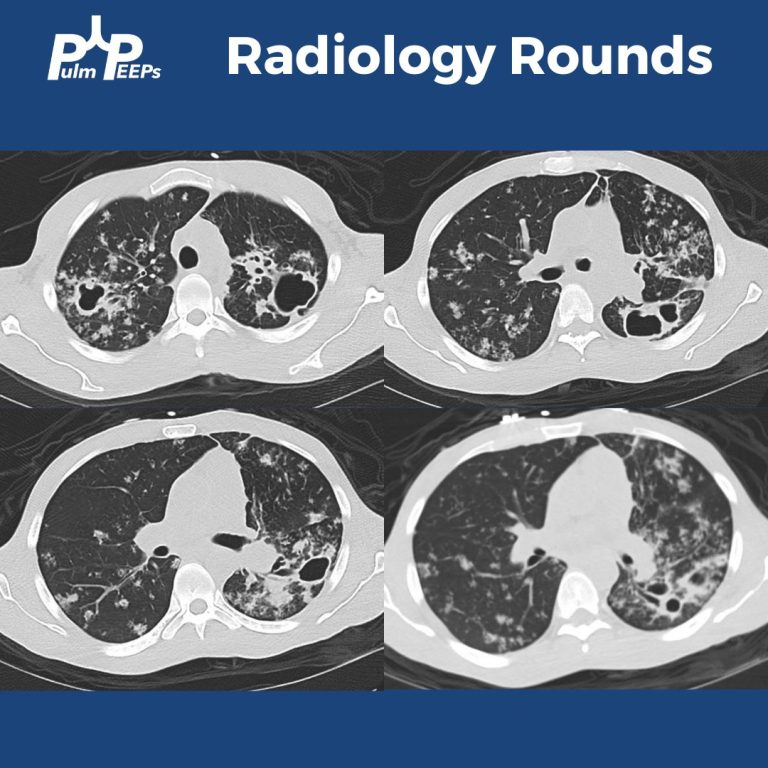 Bronchiectasis | PulmPEEPs