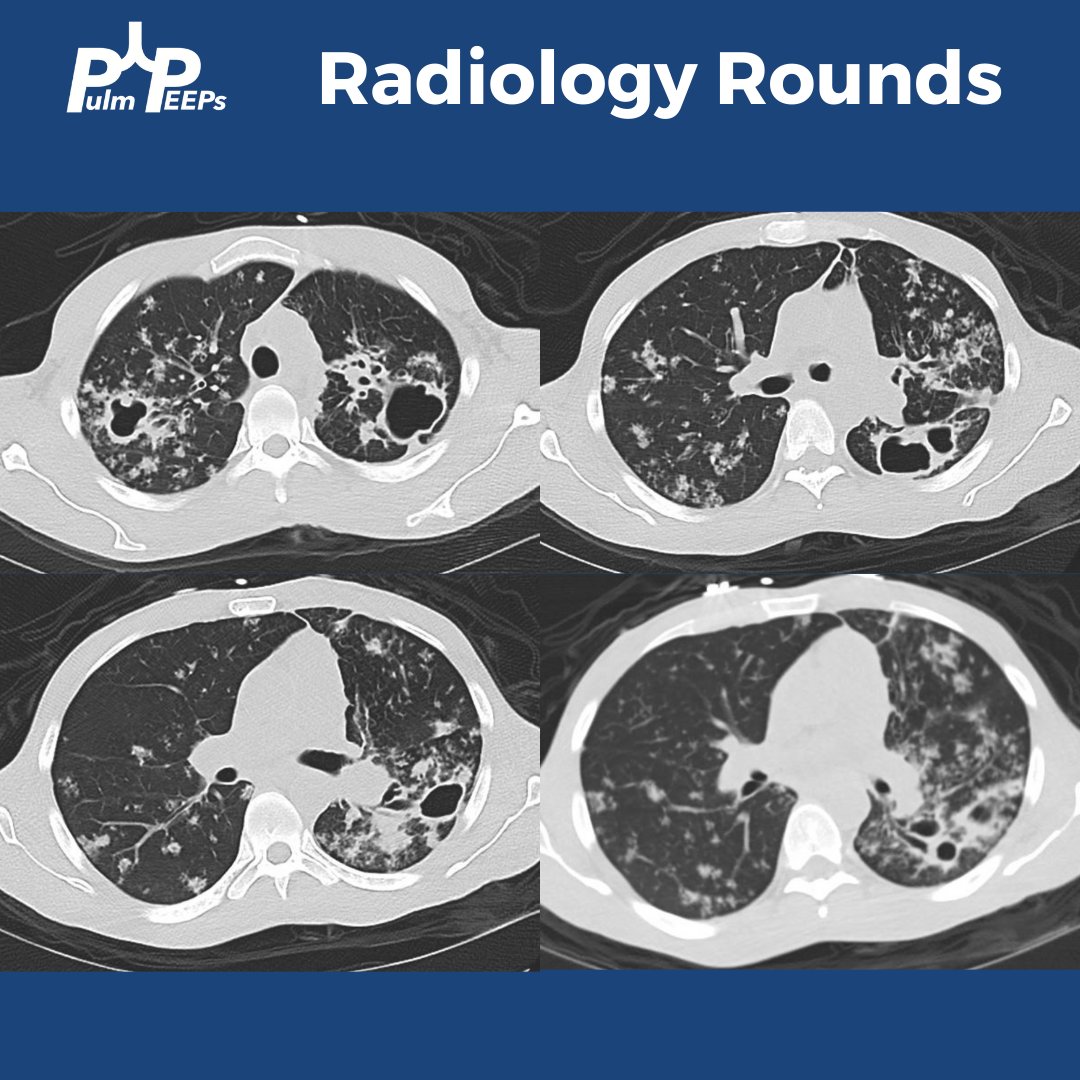 Radiology Rounds – 7/19/23 | PulmPEEPs