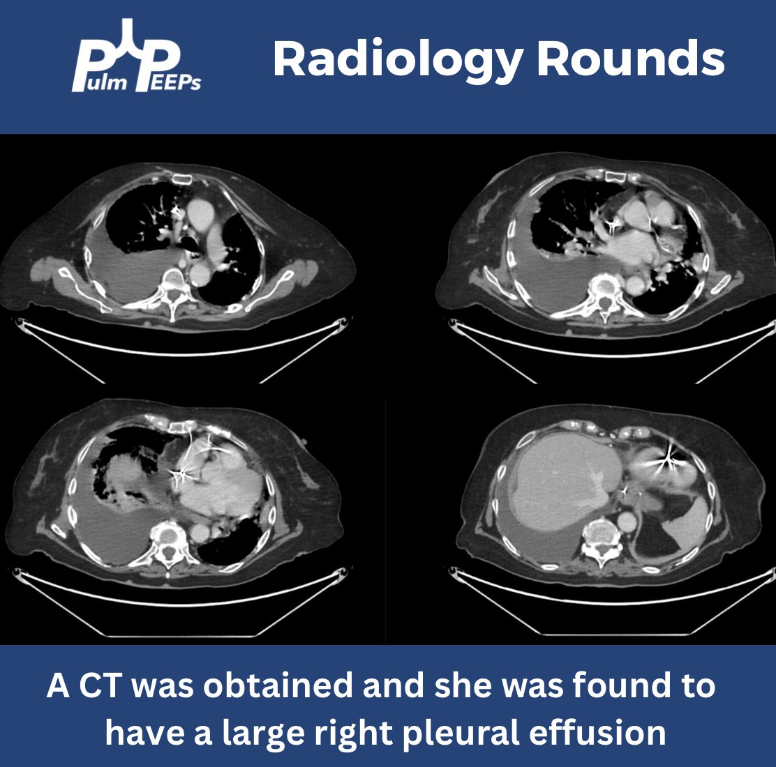 Pleural effusion | PulmPEEPs