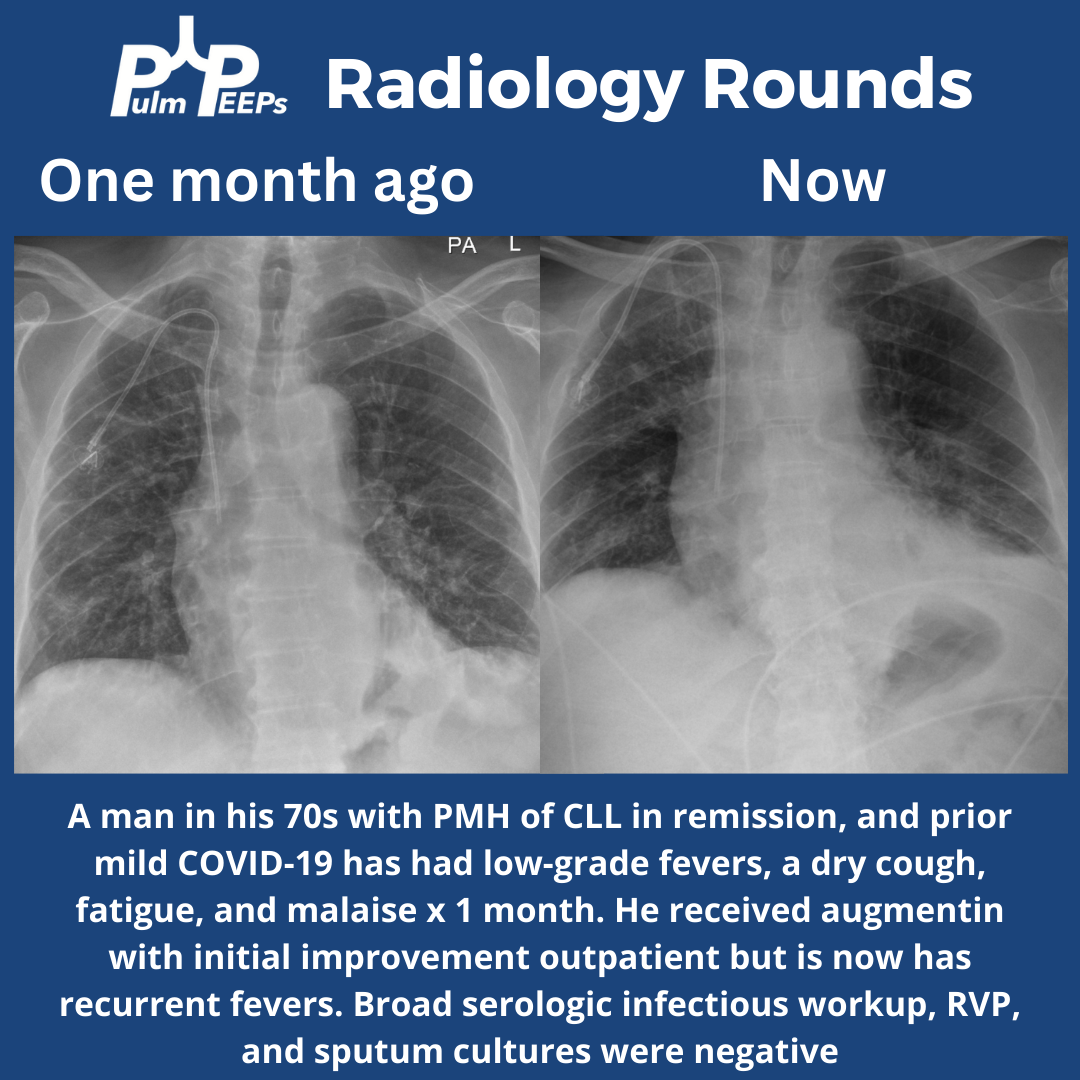 Radiology Rounds – 8/22/23 | PulmPEEPs