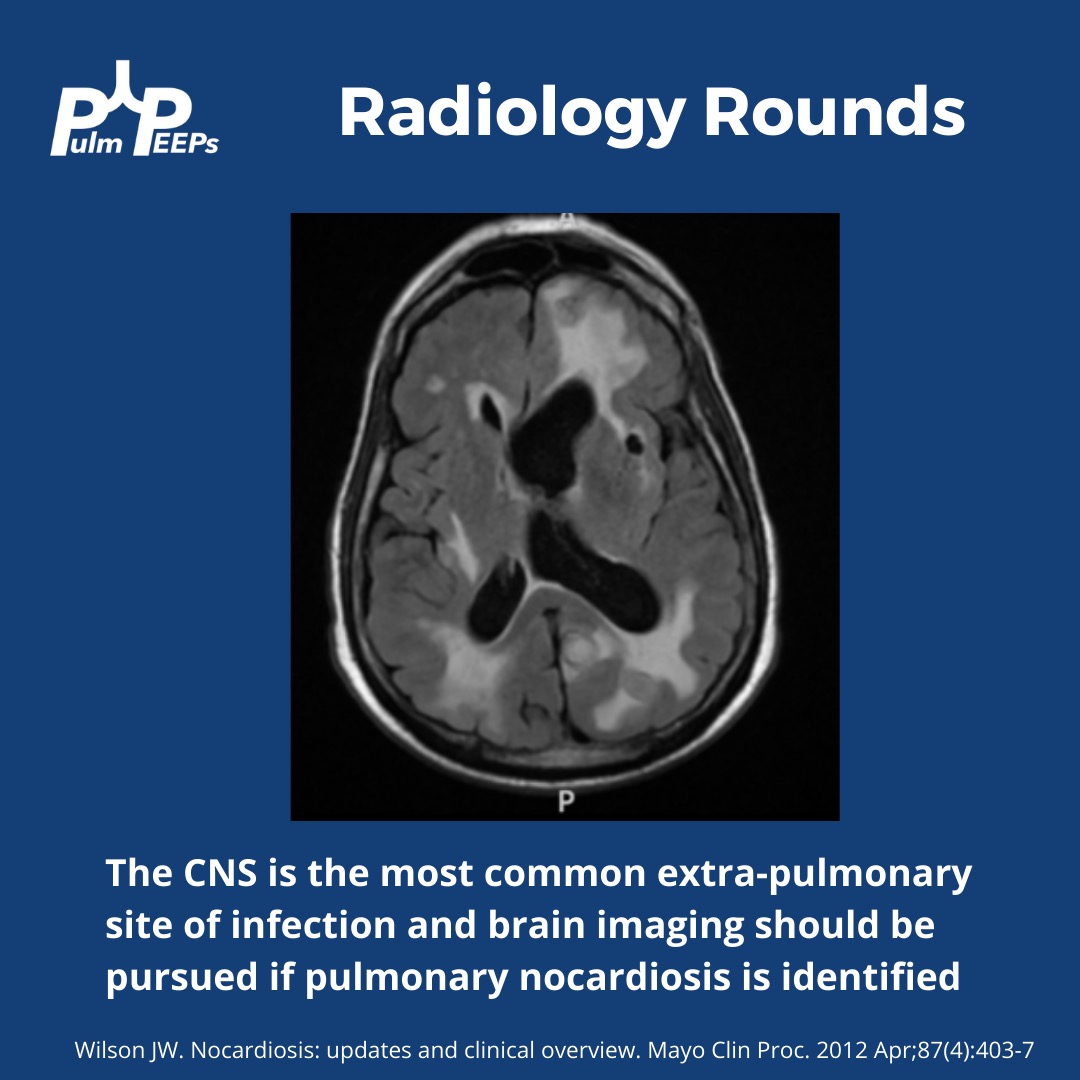 Lung nodule | PulmPEEPs