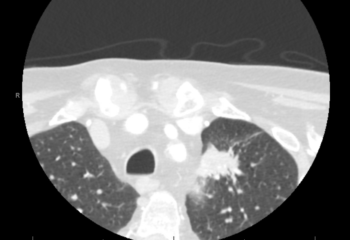 Lung nodule | PulmPEEPs