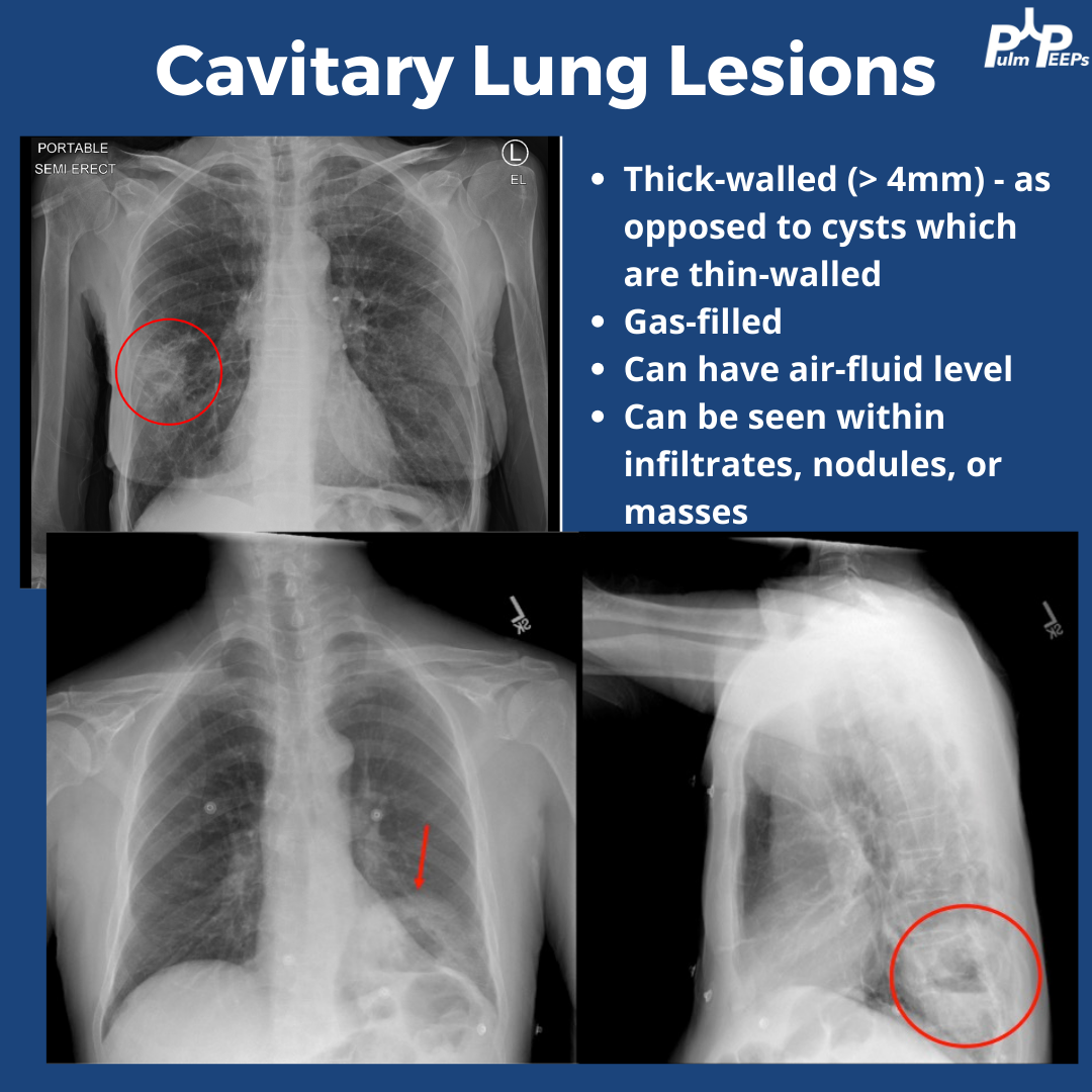 Radiology Rounds – 9/5/23 | PulmPEEPs