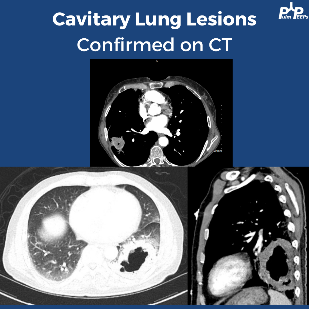 PulmPEEPs | Pulmonary and Critical Care content for learners and ...