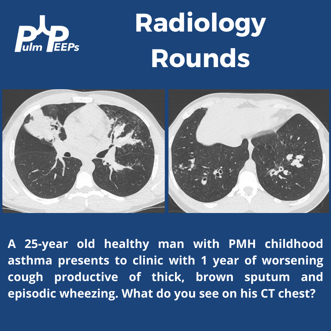 PulmPEEPs | Pulmonary and Critical Care content for learners and ...