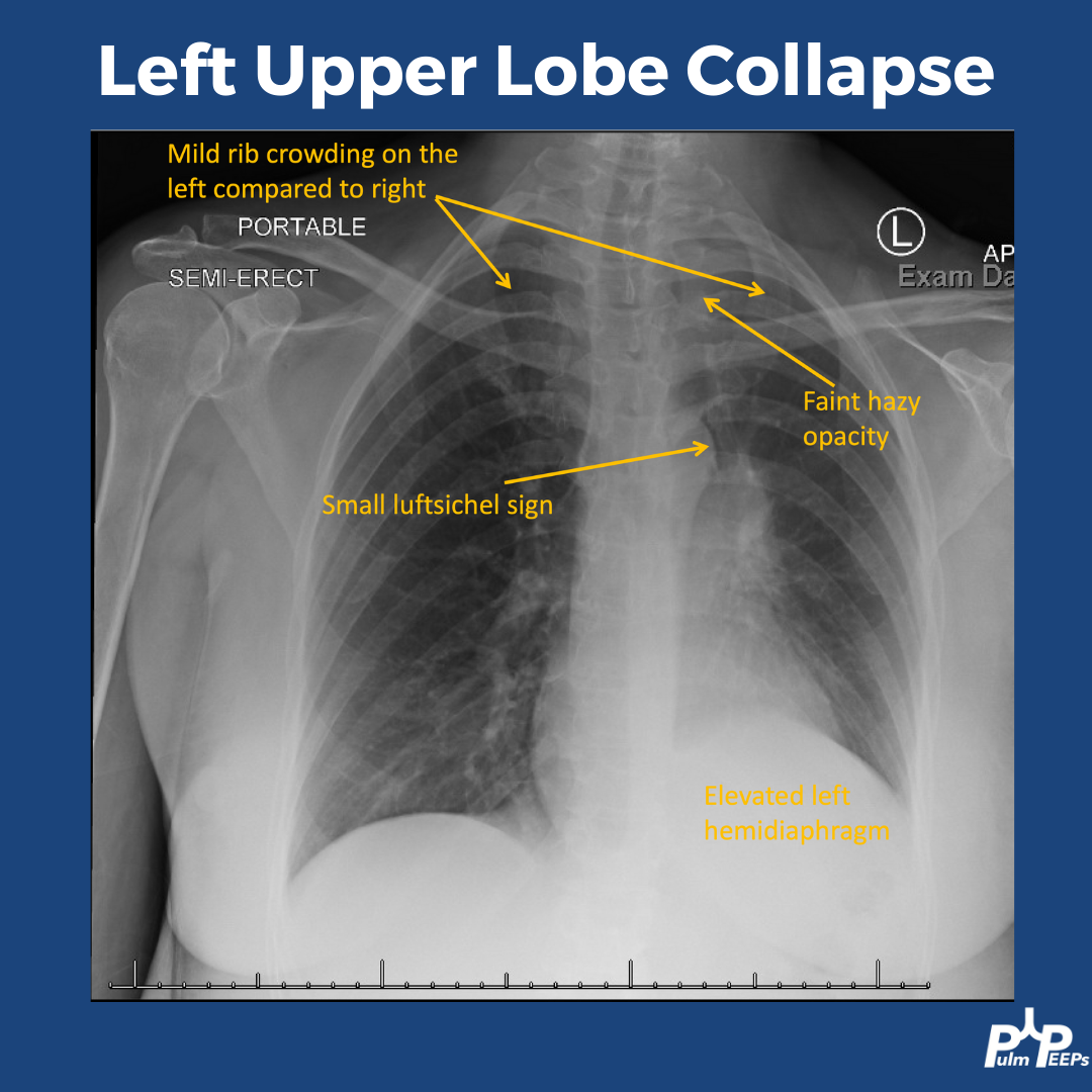 PulmPEEPs | Pulmonary and Critical Care content for learners and ...