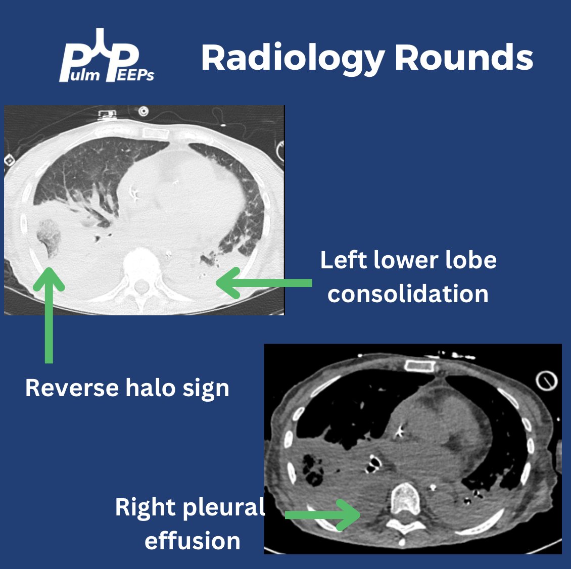 Radiology Rounds | PulmPEEPs