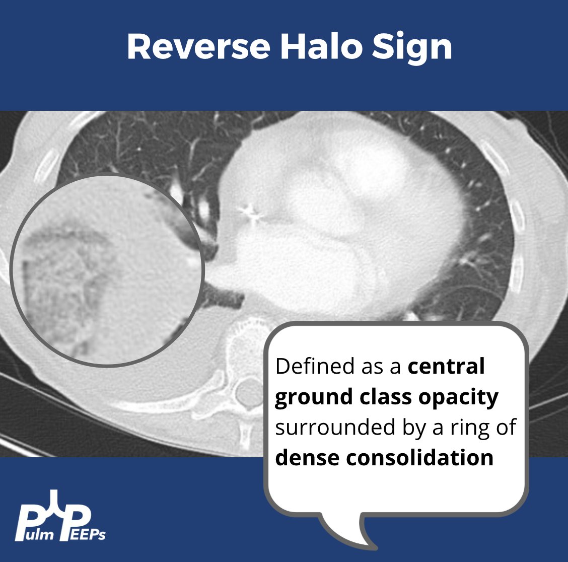 Radiology Rounds – 1/16/24 | PulmPEEPs