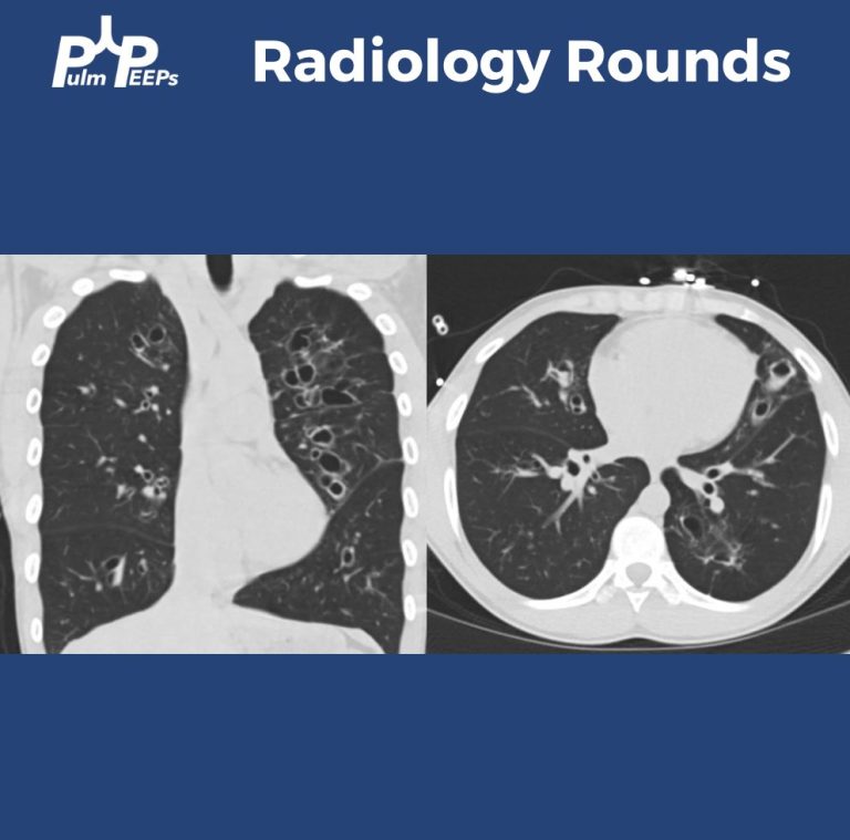 PulmPEEPs | Pulmonary and Critical Care content for learners and ...
