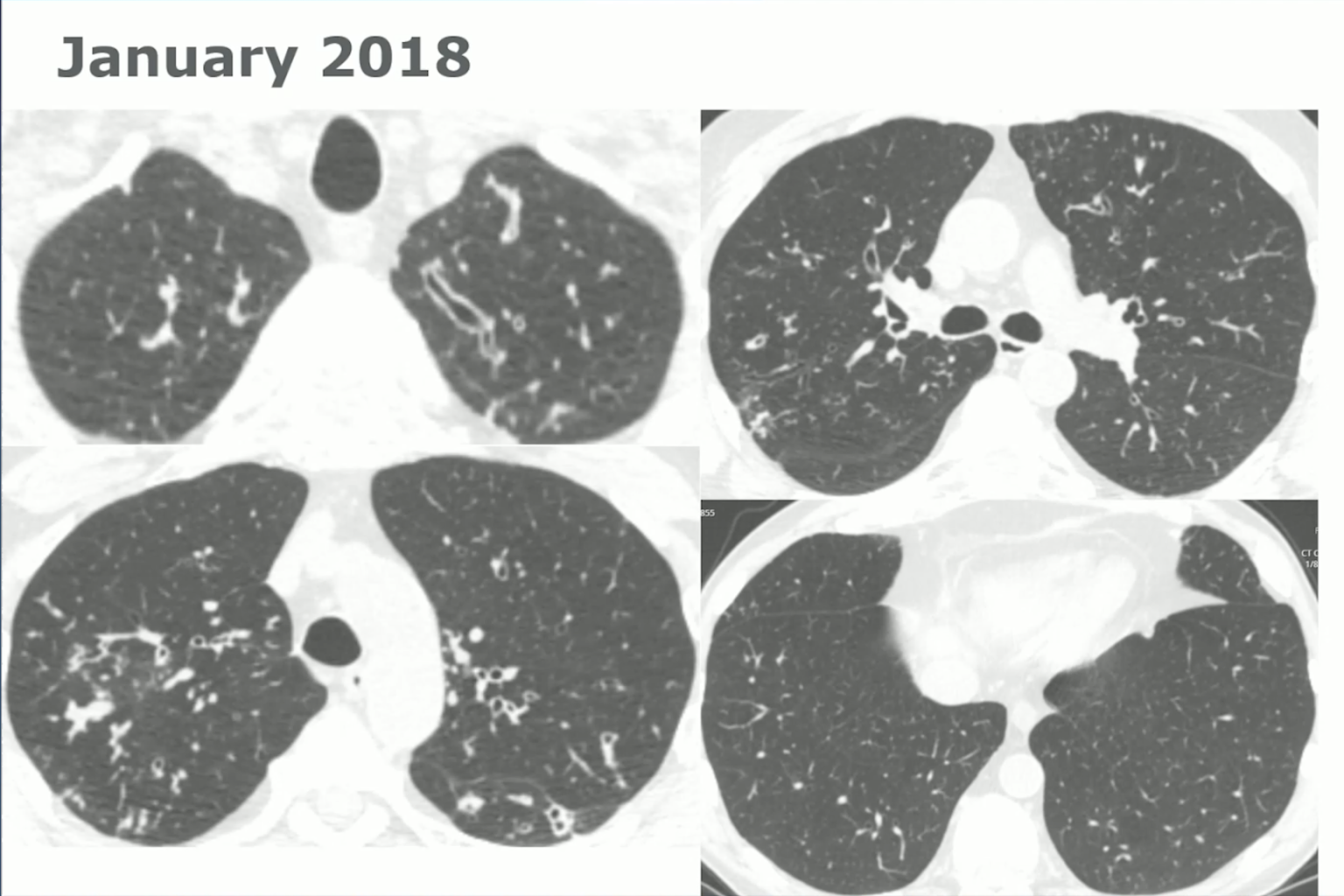 110. Pulm PEEPs at CHEST 2025 – Widened Airways and Narrowed ...